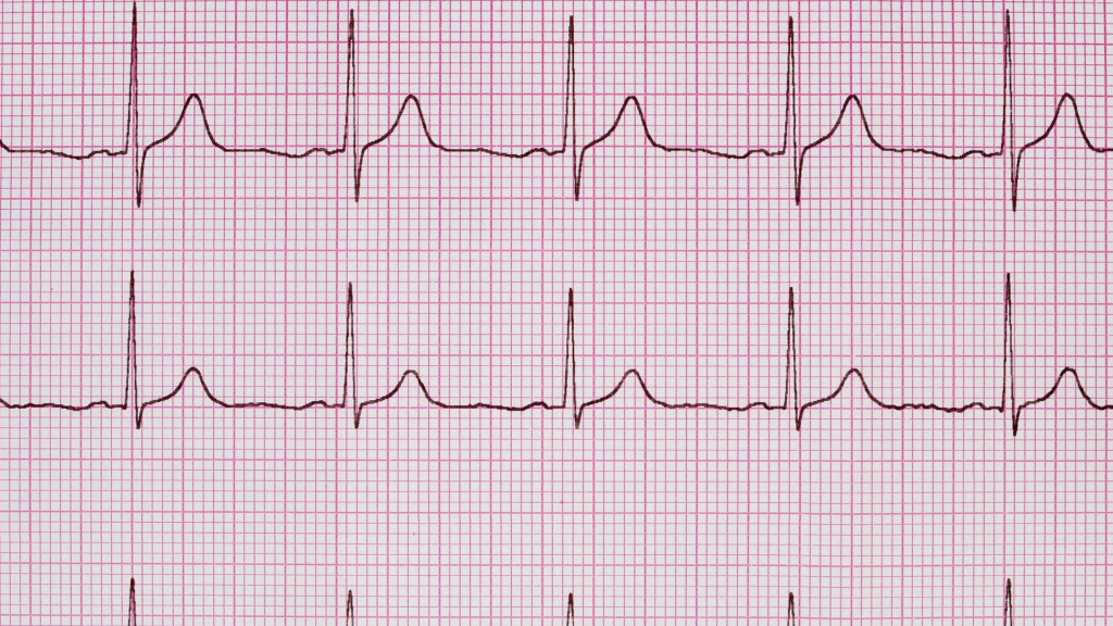 ECG Test in Kent